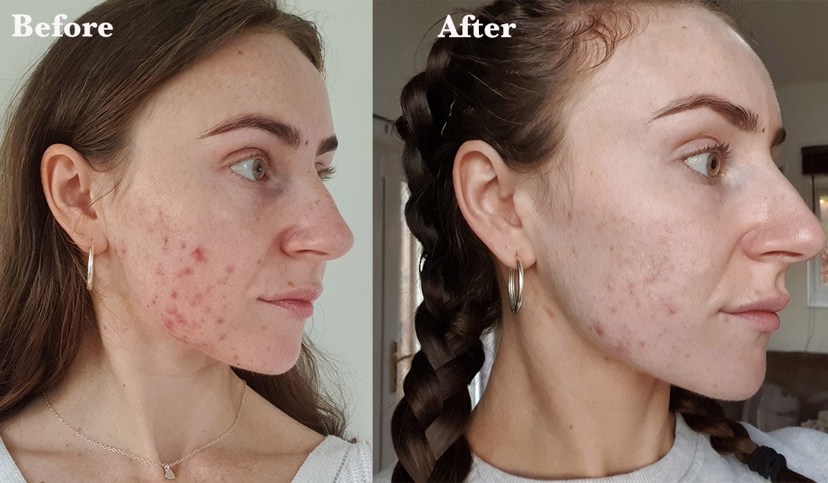 Dr Sam's Skincare review - before and after