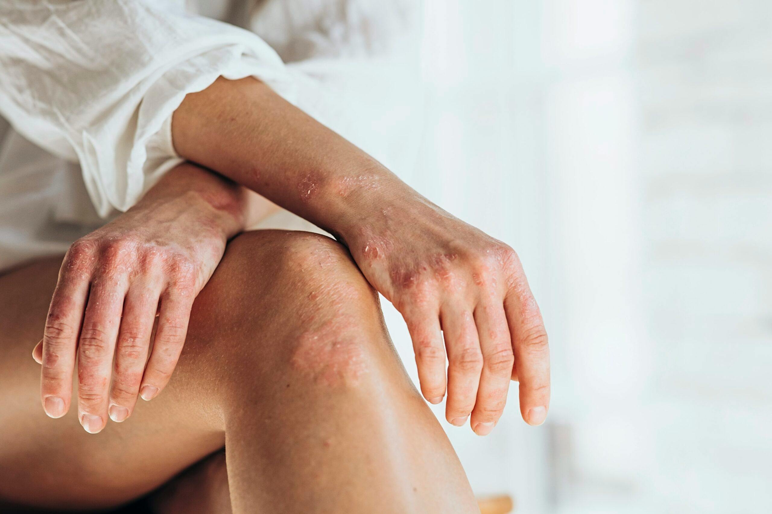 5 signs...of psoriasis: understand the symptoms of this common ...