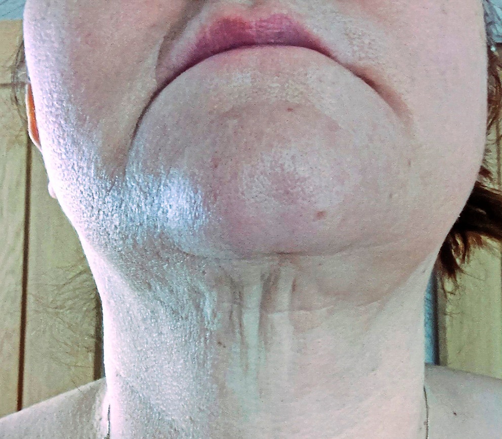 Tummy Tuck Horror: My quest for a dream body turned into a nightmare
